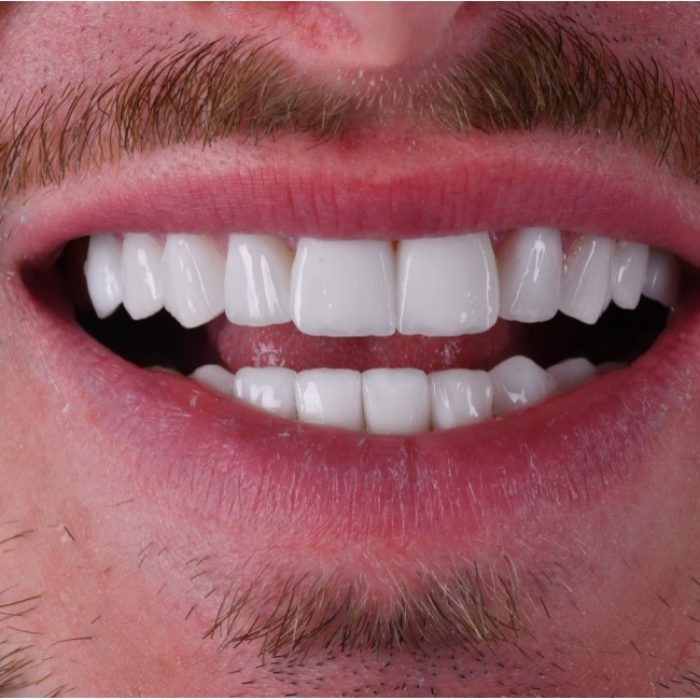 Veneers – Dental Home